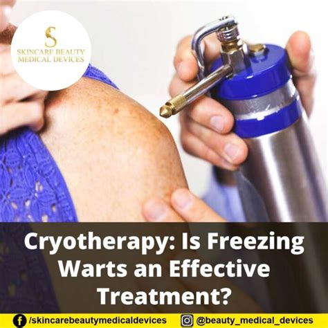 Cryotherapy Is Freezing Warts An Effective Treatment