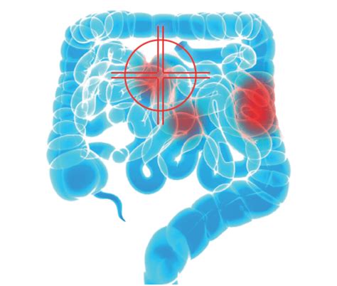 Total Ada Assays Solving The Mystery Of Drug Unresponsiveness Biohit