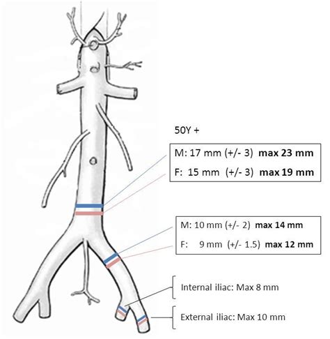 The Pump And The Tubes Pelvic Artery Ectasia Aneurysm