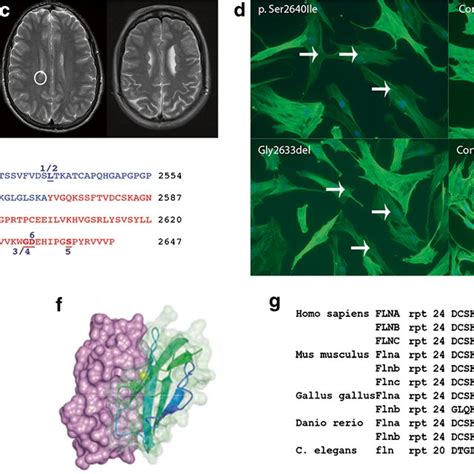 Schematic Overview Of Flna Mutations And Clinical Presentation Of The