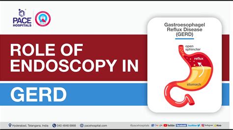 Is Endoscopy Necessary For Gerd At Janet Simmons Blog