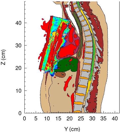 Maximum Tensile Pressure Generated Throughout Projectile Impact