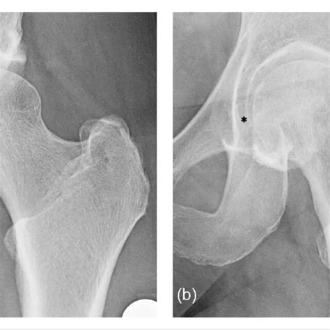 Radiographs Of The Right Hip From 2 Female Joco Oa Participants A