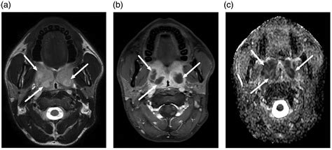 Emergency Neck Mri Feasibility And Diagnostic Accuracy In Cases Of