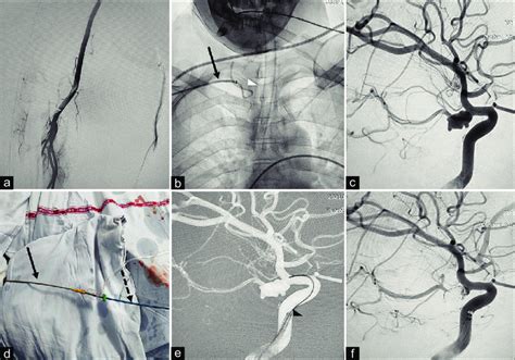 A A 37 Year Old Female Presented With Sah Due To Ruptured Right Pcom