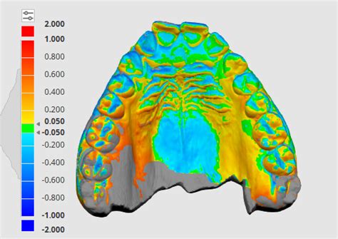 Nada K Mftsa Class Iiib With Anterior Open Bite Tongue Thrust