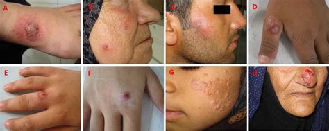 Cutaneous Leishmaniasis