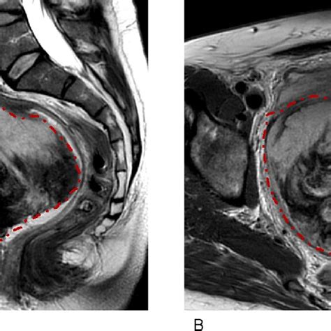 Initial Mri A Sagittal T2 Weighted Image Showing Heterogeneous
