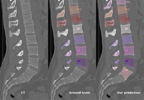 Spine Vertebrae Segmentation Gitlab