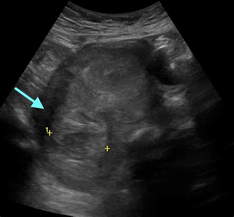 Vaginal Bleeding Due To Iatrogenic Uterine Perforation A Case Report
