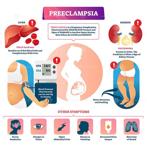 Preeclampsia Vector Illustration Vectormine