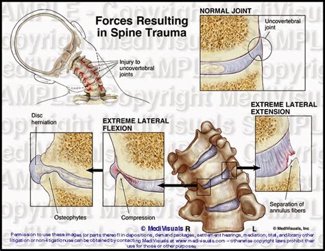 The Medical Legal Exhibit Expert Blog Understanding The Osteophyte