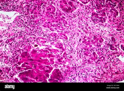Histopathology Of Subacute Severe Hepatitis Light Micrograph Photo