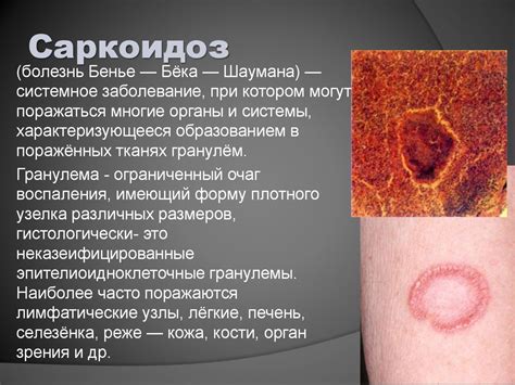 Саркоидоз презентация онлайн