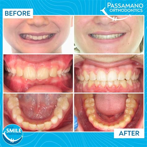 Deep Bite And Class 2 Retrusive Jaw Fixed With Braces Passamano