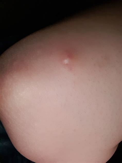 팔꿈치 염증 고름 지식in