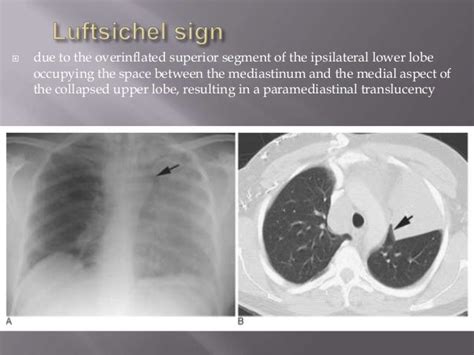 Collapse Radiology