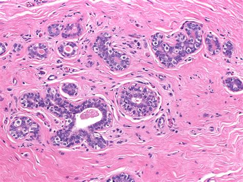 Lobular Neoplasia Atypical Lobular Hyperplasia Alh Mgh Learn Pathology