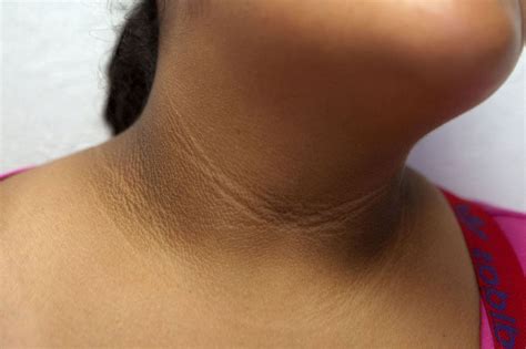 40 Facts About Acanthosis