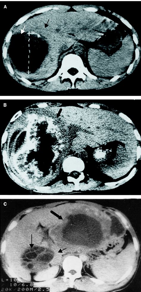 Echinococcosis The Lancet