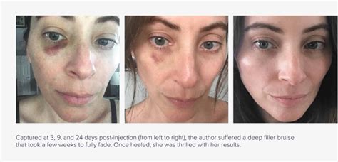 Photo Example Of Filler Bruising From Botox Injection That Amber Heard
