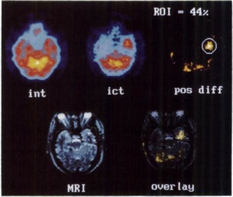 selected slice from difference analysis in patient who was injected