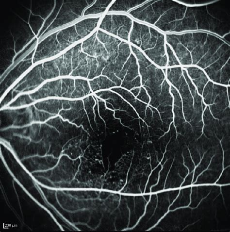 Example Of Fluorescein Angiography Show Broken Perifoveal Capillary Download Scientific Diagram