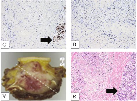 Images From The Resected Parotid Tumor A The Surgical Specimen B
