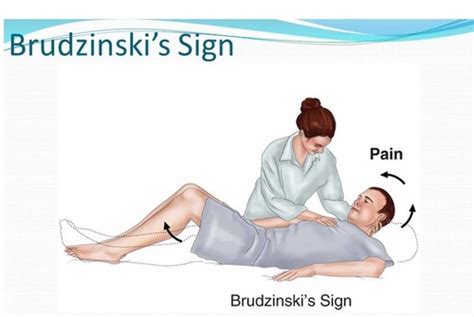 Brudzinski Sign