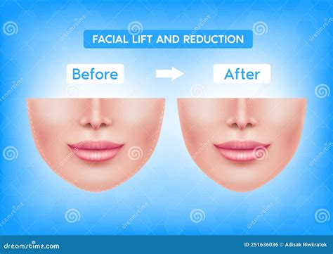 White Female Face Before After Plastic Surgery Jaw Reduction And Botox