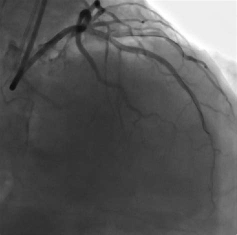 Clinical Experience Of A Novel Optical Coherence Tomography Guided
