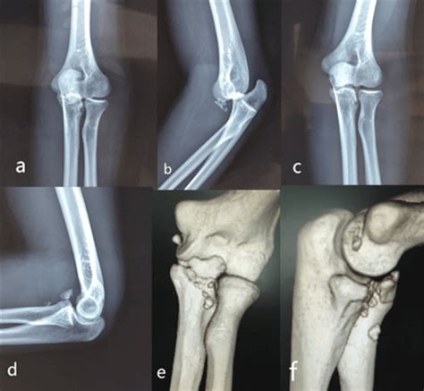 Understanding The Coronoid Process Elbow An Essential Guide