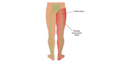 Yoga And Sciatica Dos And Donts To Consider