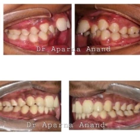 Skeletal Class 2 Case Treated Without Extraction In An Adolescent