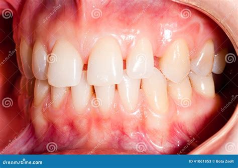 Space Between Teeth Stock Image Image Of Oral Clinical 41061853