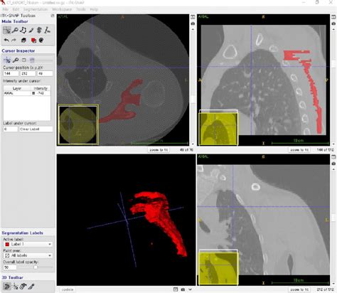 Itk Snap Version Was Used For Reconfiguring Computed Tomography