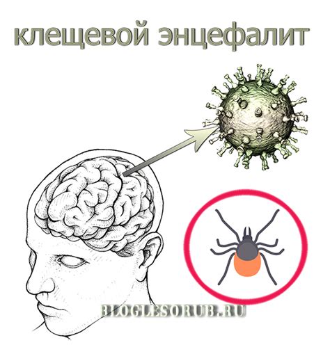Клещевой энцефалит