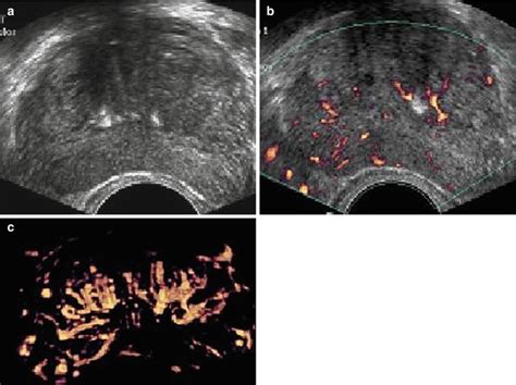 Power Doppler Imaging Of Prostate Cancer Radiology Key