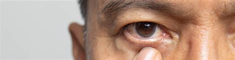 Cataracts Causes Diagnosis And Treatment Options