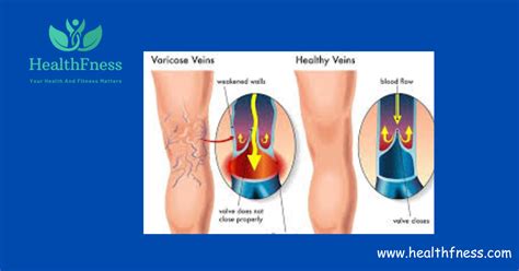 When To Worry About Varicose Veins When Its Time To Take Action2024 Healthfness