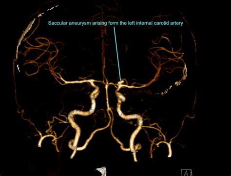 Ct Case 022 • Litfl • Ct Scan Interpretation