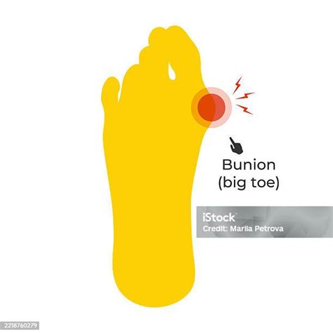 Hallux Valgus 변형이 있는 발 밑창의 실루엣 엄지 발가락의 고통스러운 건막류 벡터 일러스트 레이 션 건강관리와 의술에 대한 스톡 벡터 아트 및 기타 이미지