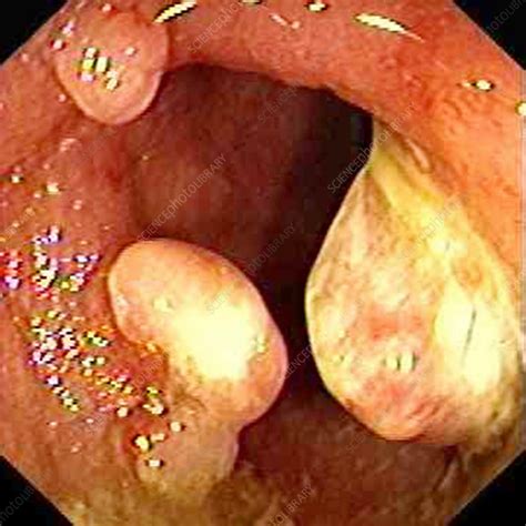 Inflammatory Polyps In Ulcerative Colitis Stock Image C0270253