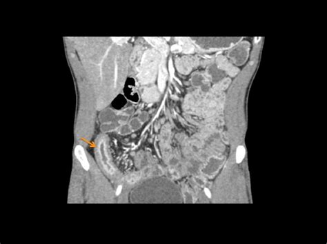 Figure 1 From Multidetector Computed Tomography Of Crohns Disease A