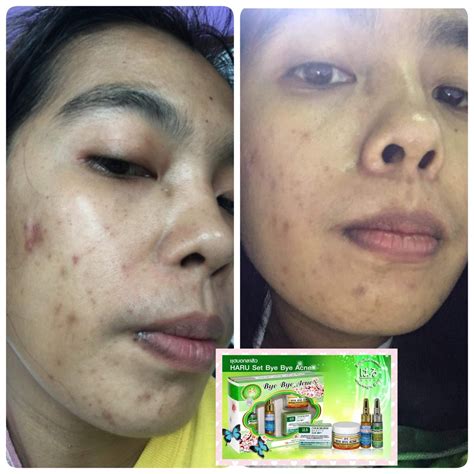 ห น้ า แ พ้ ส า ร สิ ว ครีมฮารุ สลายฝ้า กระหนา ลดริ้วรอย