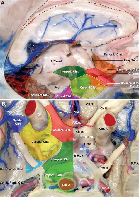 Basal Cisterns Anatomy
