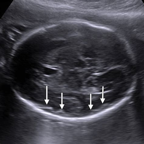 Inverted T Sign In Twin Pregnancy Twin Peak Lambda Sign