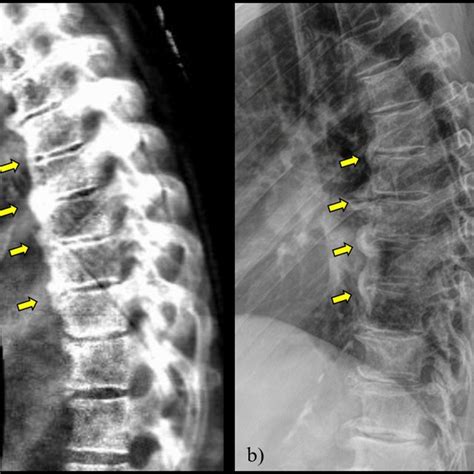 Physiotherapy Intervention For Forestiers Disease Patient Download