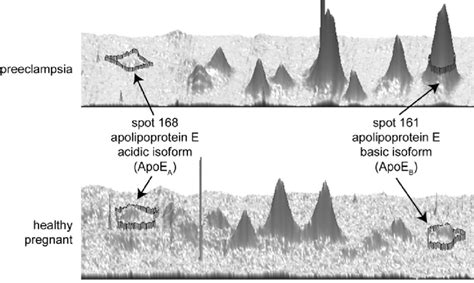 Three Dimensional Spot Volumes Of Apolipoprotein E Isoforms Spot