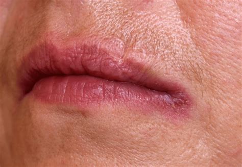 13개의 Cheilosis Stomatitis 이미지 스톡 사진 3d 오브젝트 벡터 Shutterstock